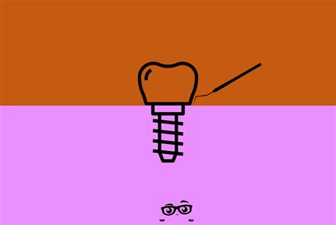 Andre Creates A Way To Perio Chart An Implant In Eaglesoft When A Tooth