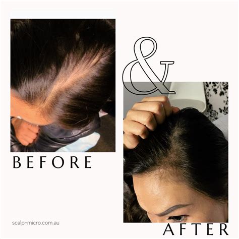SMP Gallery See Scalp Micro Results Book A Consultation