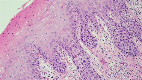 Your Pathology Report For Differentiated Vulvar Intraepithelial