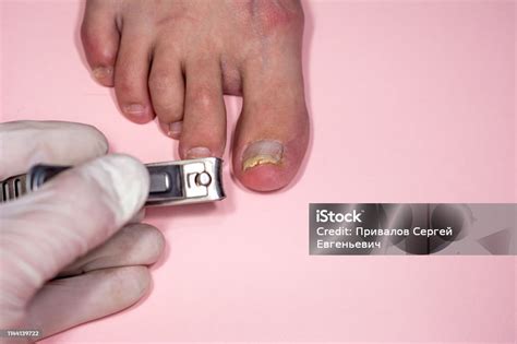 분홍색 배경에 고립 된 손 발톱 장갑에 있는 닥터의 손은 못에 손상을 검사 합니다 손톱 판에 기계적 손상 쉘 락 또는 젤 바니시 를 바른 후 손톱 손상 건강관리와 의술에