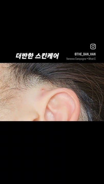 더반한 귀 근처 압출 용인동백 더반한스킨케어 압출영상 Shorts Youtube