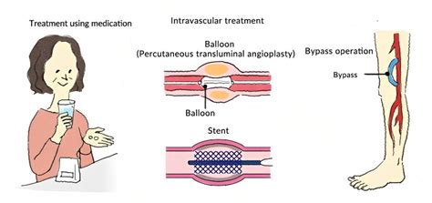 Peripheral Vascular Disease Pvd Treatment In Mumbai