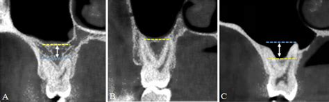 schematic diagram of classification of maxillary sinus pneumatization