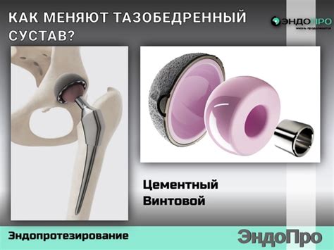 Как меняют тазобедренный сустав Операция по замене тазобедренного сустава длится примерно 1 5