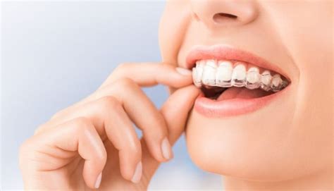 Byte Aligners Before And After Byte Reviews