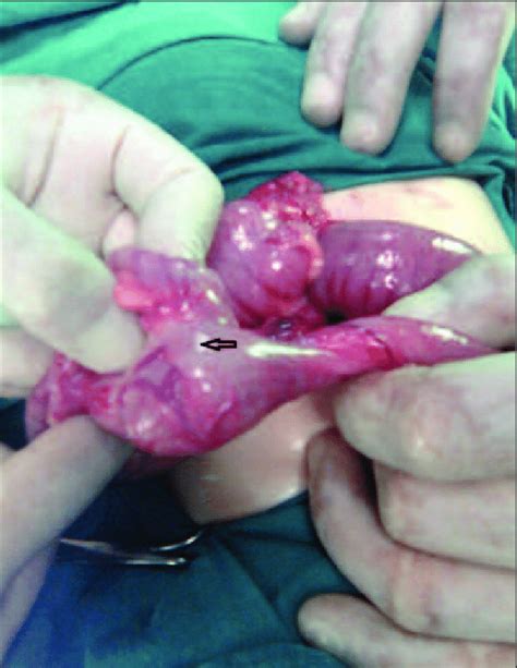 Cystic Mass In The Antimesenteric Area Of The Caecal Wall Download