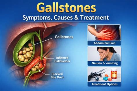 What Are Gallstones Signs Causes And Treatment Guide