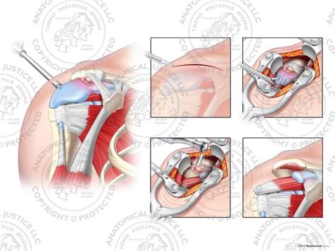 Right Open Acromioplasty With Partial Bursectomy No Text