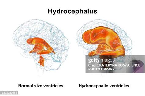 Macrocephaly Photos And Premium High Res Pictures Getty Images