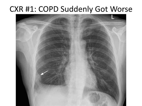 Ppt Copd Exacerbations Powerpoint Presentation Free Download Id