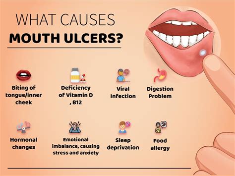 Best Medicine For Mouth Ulcer In India Planmymedical