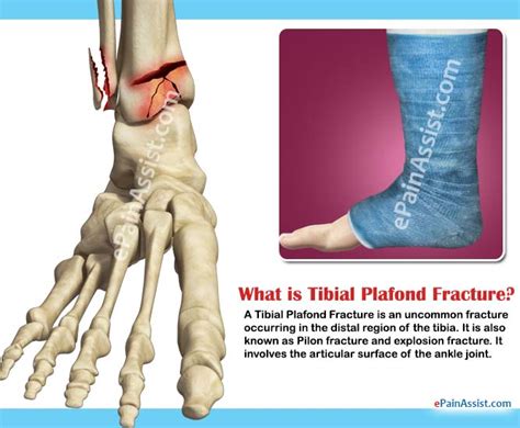 Tibial Plafond Fracture Classifications Symptoms Treatment Signs Diagnosis