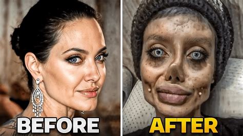 Plastic Surgery Gone Wrong Photos Before And After