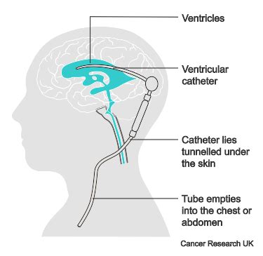 Surgery To Remove Fluid Brain And Spinal Cord Tumours Cancer Research UK