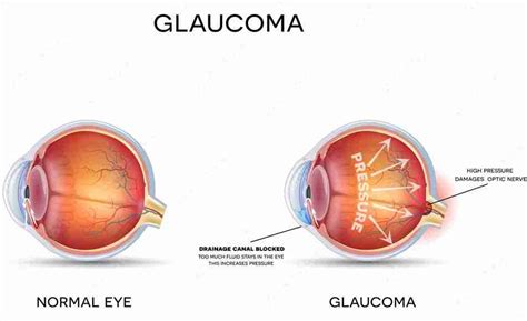Glaucomas Symptoms Causes And Management Philip D Izaac