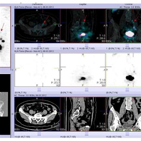 Schematic Representation Of The Sentinel Lymph Node Sln Concept Download Scientific