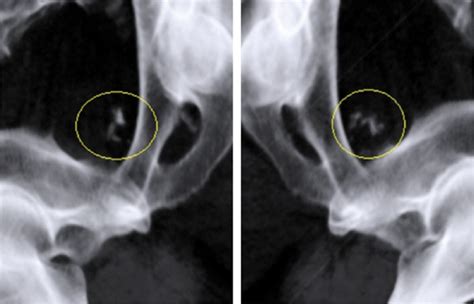 Examples Of Exactrac X Ray Images Intra Prostatic Calcifications Were