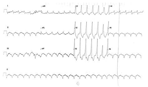 Emergency Medicine Educationecg Pointers The Lewis Lead