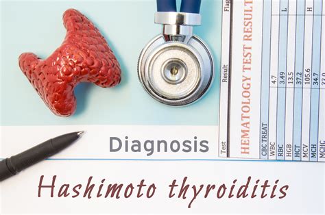 Case Report Severe Proximal Myopathy Can Be Secondary To Hypothyroidism Hashimoto Thyroiditis