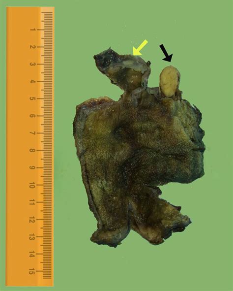 Gross Image Of The Excised Gallbladder Cut Section Revealed A