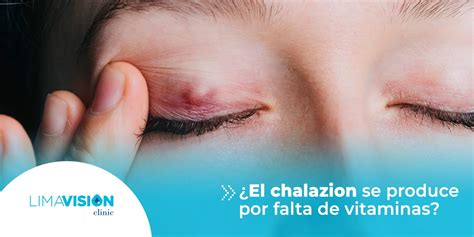 Chalazion ¿qué Es Como Se Trata Y Diferencias Con El Orzuelo