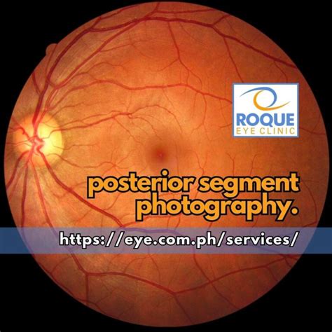 Posterior Segment Photography Roque Eye Clinic Ph