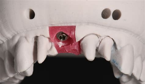 Monolithic Multilayer Zirconia Crowns In The Esthetic Zone