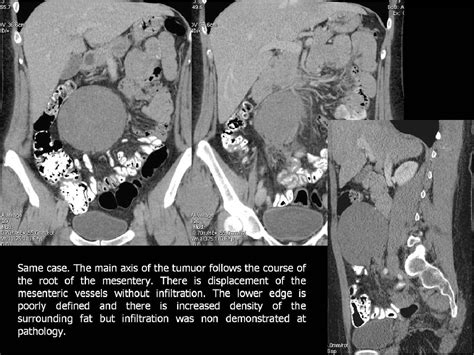 Figure 1 From Root Of Mesentery Anatomic And Pathologic Review Semantic Scholar