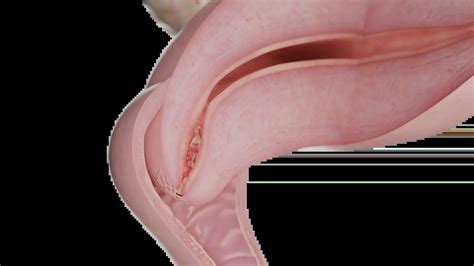 Cervicitis Causas Síntomas Signos Diagnóstico Y Tratamiento