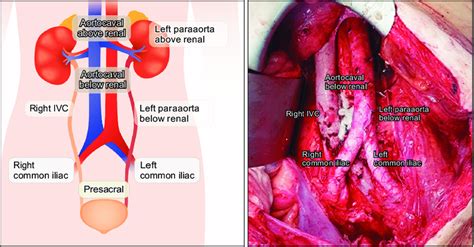 Surgical Areas Of Paraaortic Lymph Node Dissection Ivc Inferior Vena Download Scientific
