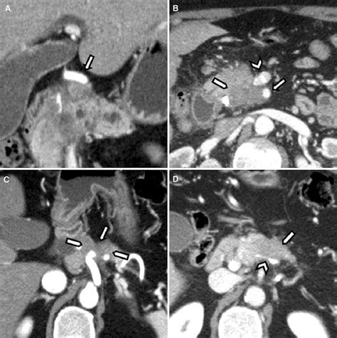 Features Of Borderline Resectable Pancreatic Adenocarcinoma As