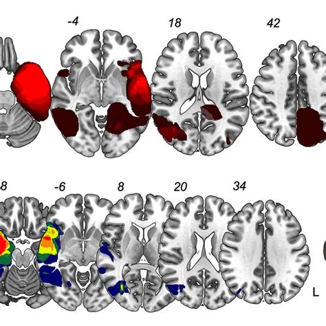 Overlapping Maps Of Resection Cavities A An Overlapping Map Of All