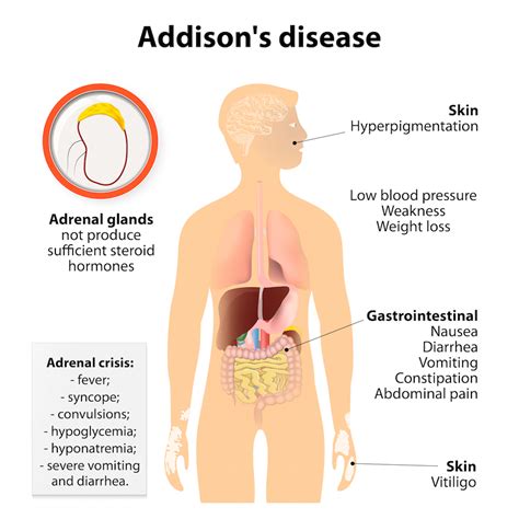 Addisons Disease Adrenaline Dasteb