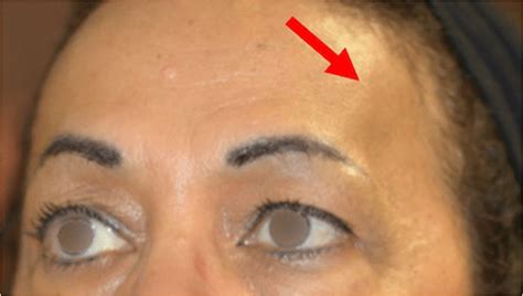 Postoperative Temporal Muscle Atrophy Red Arrow Left Temporal