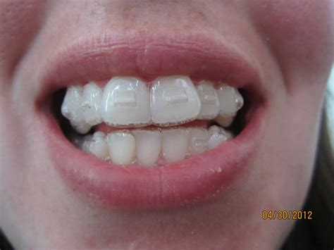 How To Place Invisalign Buttons At Angela Prasad Blog