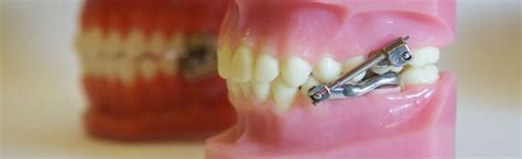 Embracing The Future Of Overbite Correction The Flip Lock Herbst
