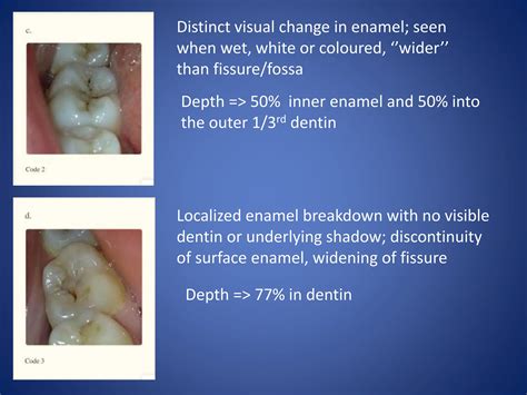 Primary Caries Secondary Caries Tertiary Caries Ppt