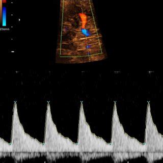 PDF ISUOG Practice Guidelines Updated Use Of Doppler Velocimetry