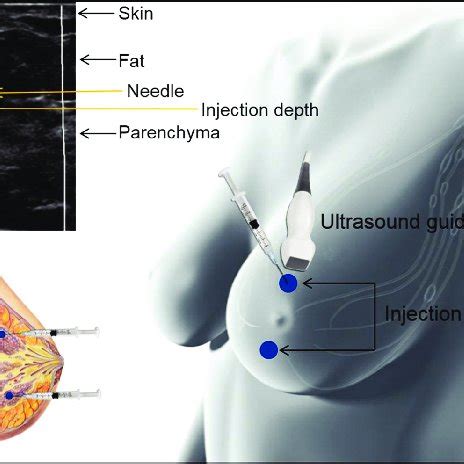 Schematic Model Of The Modified Injection Techniques Download