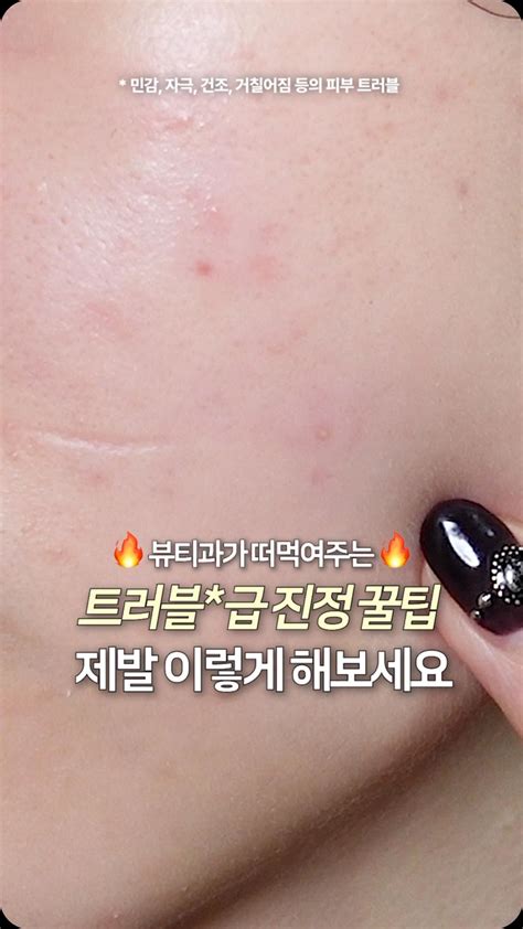 박체리 Cherry🍒 광고 트러블 진정 진짜 급할 때 제발 이렇게 해 보세요🙏 올영 꿀템 올영추천템 트러블세럼 파티온 트러블 여드름 올리브영추천템 꿀팁