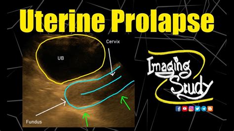 Uterine Prolapse Ultrasound Case 223 Youtube