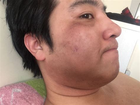 脸上黑色素 色素异常 伤感说说吧