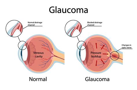 Congenital Glaucoma Diagram