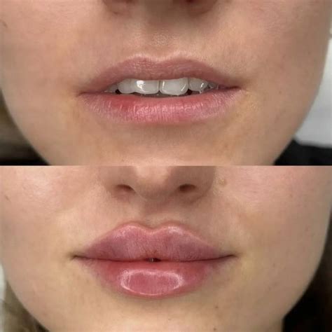 잡담 러시안 입술필러 라는게 한국에도 있어 인스티즈instiz 일상 카테고리