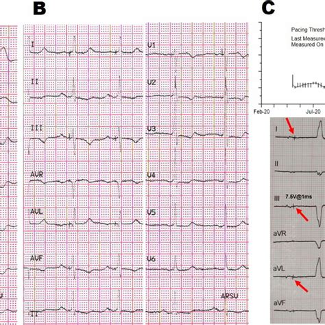Selective His Bundle Pacing Hbp With Lbbb Correction Ab 83 Years Download Scientific