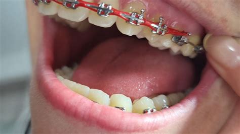 Nicolerivas Braces And Mouth With Saliva Fetish Manyvids