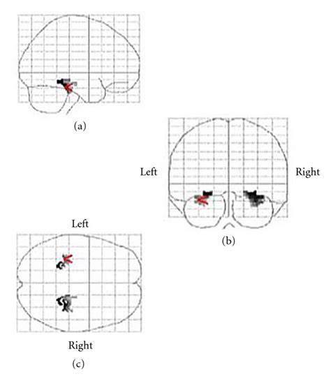 Relatively Symmetrical Mesial Temporal Structures Are Activated In The Download Scientific