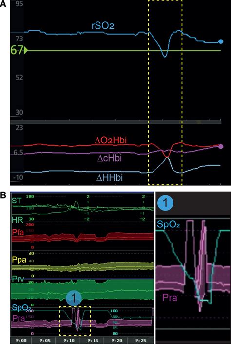 Early Detection And Correction Of Cerebral Desaturation With