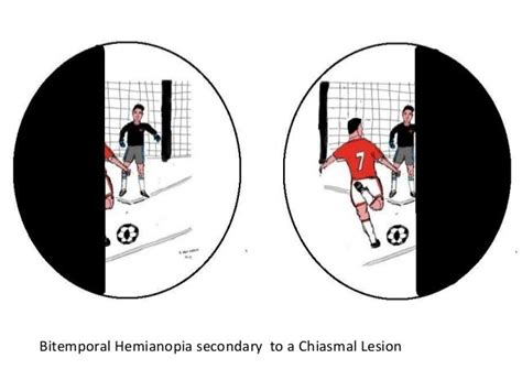 Visual Field Defects