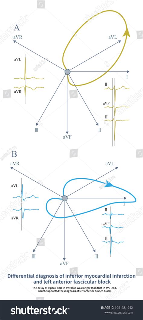 Ecg Left Anterior Fascicular Block Inferior 库存插图 1951384942 Shutterstock